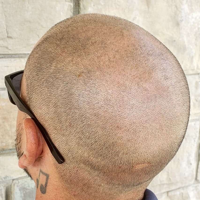 Where to Get Scalp Micropigmentation in Toronto – Chronic Ink